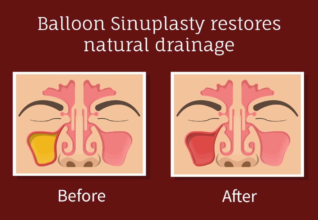 In-Office Sinus & Nasal Treatments | West Texas ENT